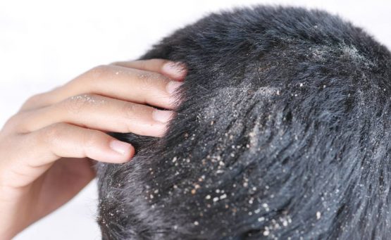 What is dandruff? What are the main causes? How to get rid of it?
